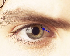 Laser Iridotomy St. Leonards | Angle Closure Glaucoma Symptoms North Shore